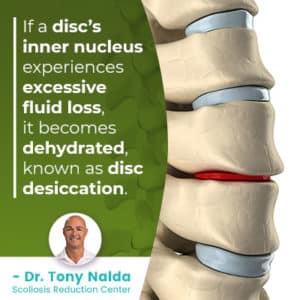 What Is Disc Desiccation? Causes, Symptoms, and Treatment