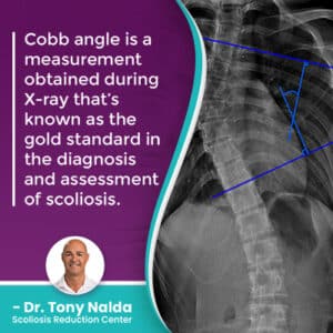 Scoliosis X-Rays: Why Scoliosis-Specific X-Rays Are Important