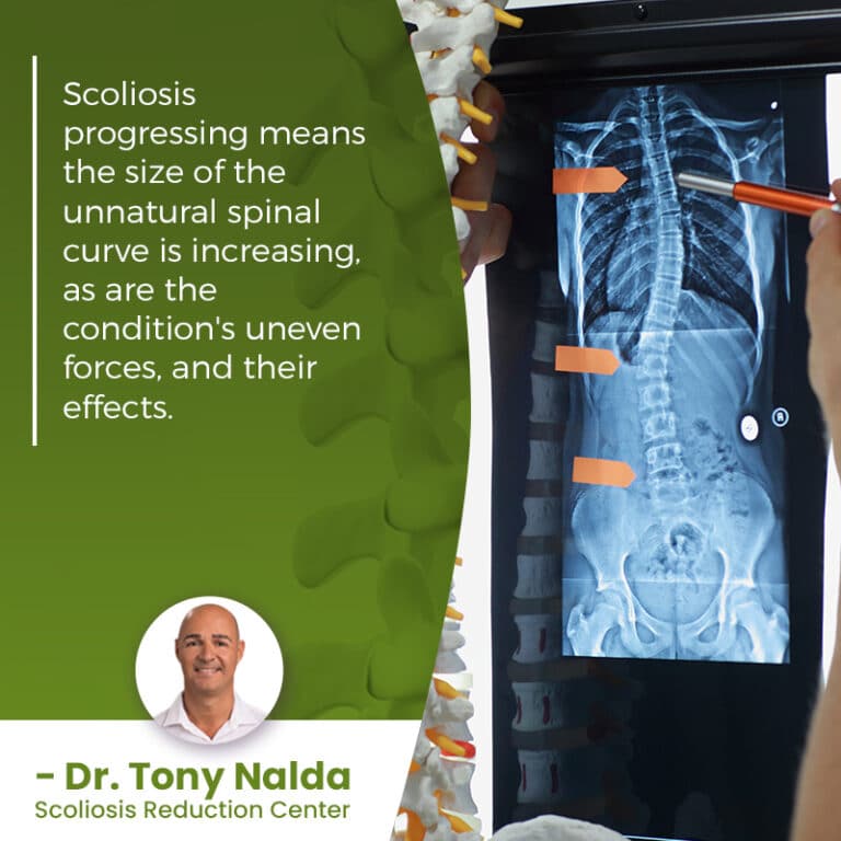 Scoliosis 15 Degrees: Symptoms, Management And Insights